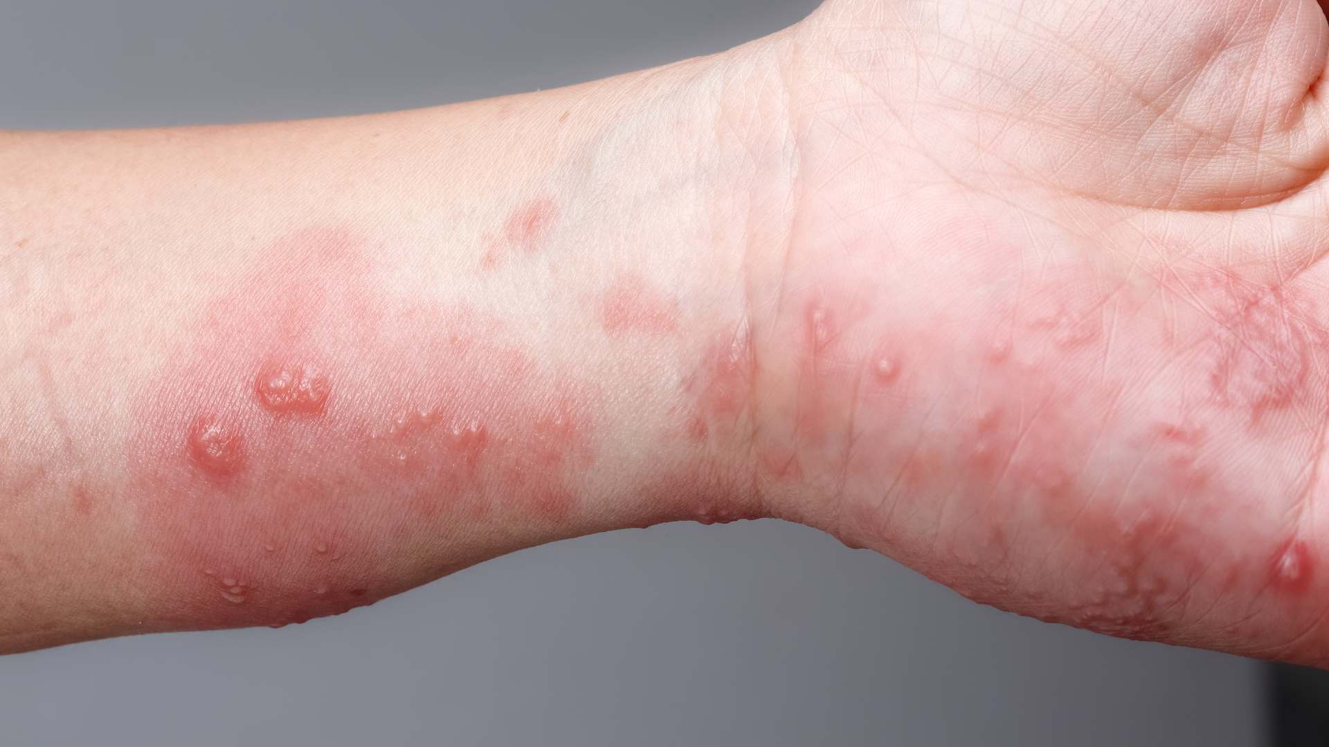Effective Scabies Treatment in Lahore - Dr Amina's Skin Clinic